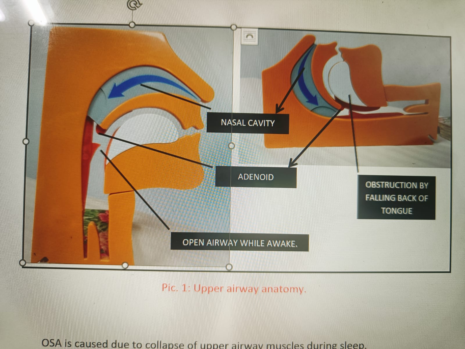 SURGERIES VS CPAP- TREATMENT OF OSA – Neurology & Sleep Centre